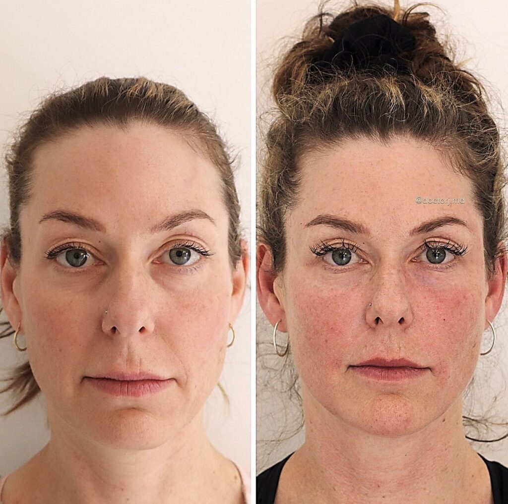 Non-Surgical Facelift Procedures Vancouver | One Clinic MD